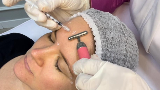Botox: conheça mais sobre a técnica que rejuvenesce a face