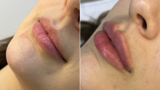 Tudo sobre preenchimento labial
