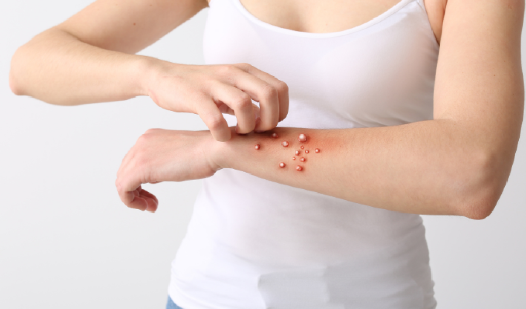 Sumaré confirma primeiro caso da doença Monkeypox em paciente mulher